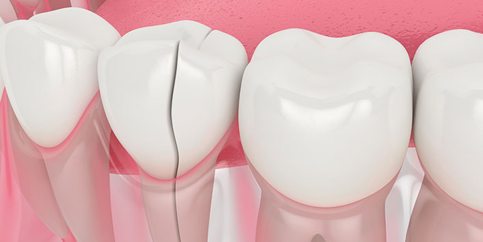 Types of Dental Root Fractures Poway, CA | Oak Tree Dental | Root ...
